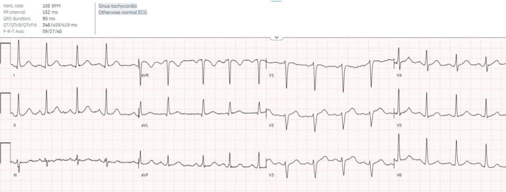 The ECG in the diagnosis of aortic dissection | ECG Cases | EM Cases