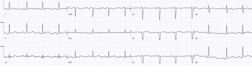 The ECG in the diagnosis of aortic dissection | ECG Cases | EM Cases