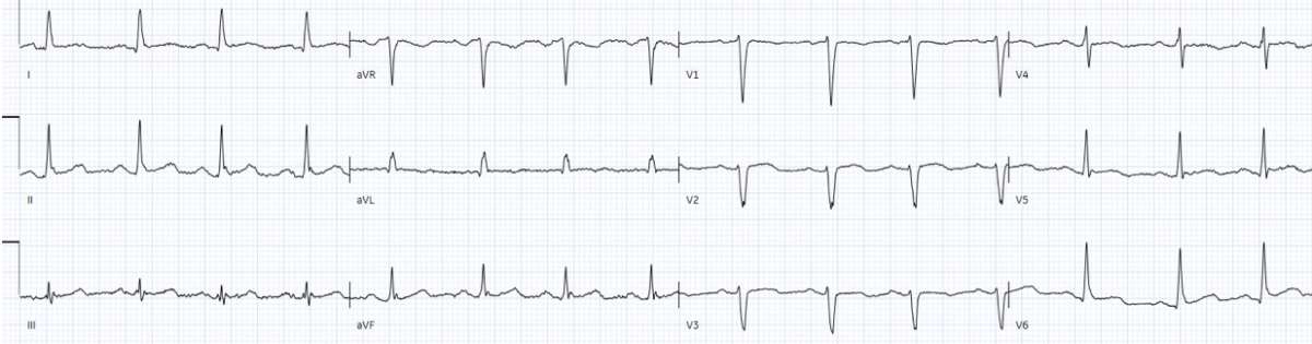 The ECG in the diagnosis of aortic dissection | ECG Cases | EM Cases