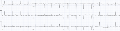 The ECG in the diagnosis of aortic dissection | ECG Cases | EM Cases