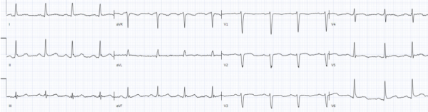The ECG in the diagnosis of aortic dissection | ECG Cases | EM Cases