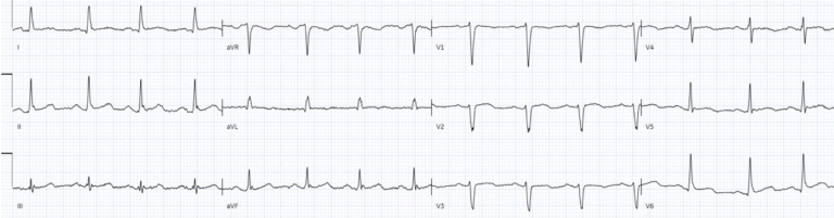 The ECG in the diagnosis of aortic dissection | ECG Cases | EM Cases