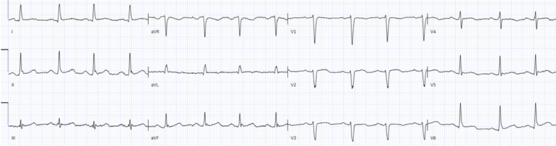 The ECG in the diagnosis of aortic dissection | ECG Cases | EM Cases
