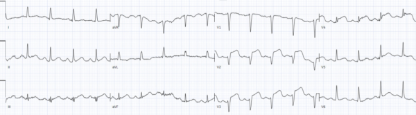 The ECG in the diagnosis of aortic dissection | ECG Cases | EM Cases