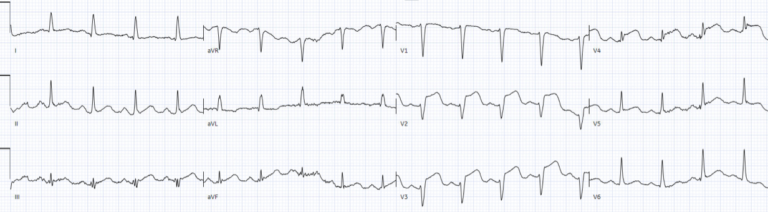 The ECG in the diagnosis of aortic dissection | ECG Cases | EM Cases
