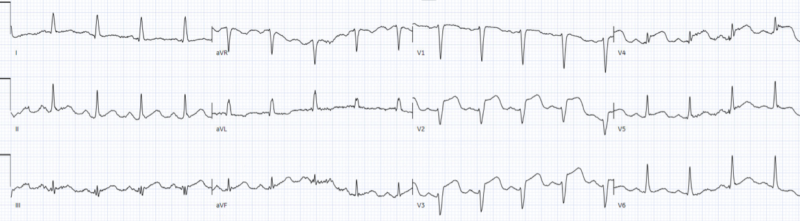 The ECG in the diagnosis of aortic dissection | ECG Cases | EM Cases