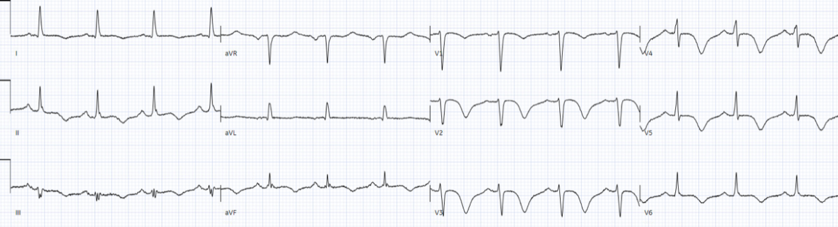The ECG in the diagnosis of aortic dissection | ECG Cases | EM Cases