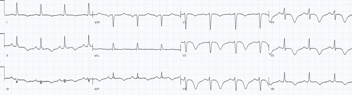 The ECG in the diagnosis of aortic dissection | ECG Cases | EM Cases