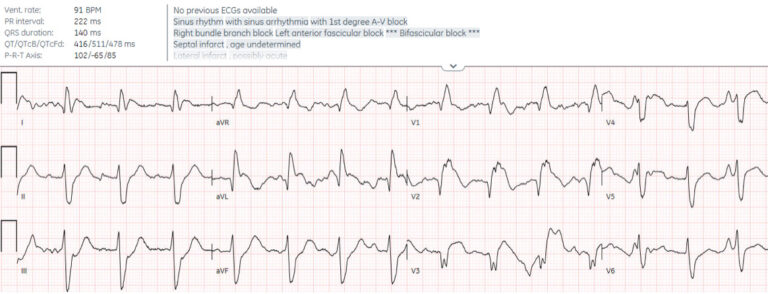 The ECG in the diagnosis of aortic dissection | ECG Cases | EM Cases