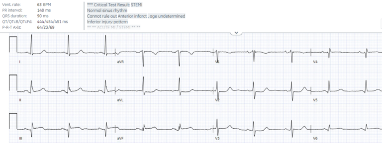 The ECG in the diagnosis of aortic dissection | ECG Cases | EM Cases