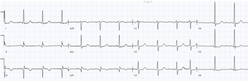 The ECG in the diagnosis of aortic dissection | ECG Cases | EM Cases