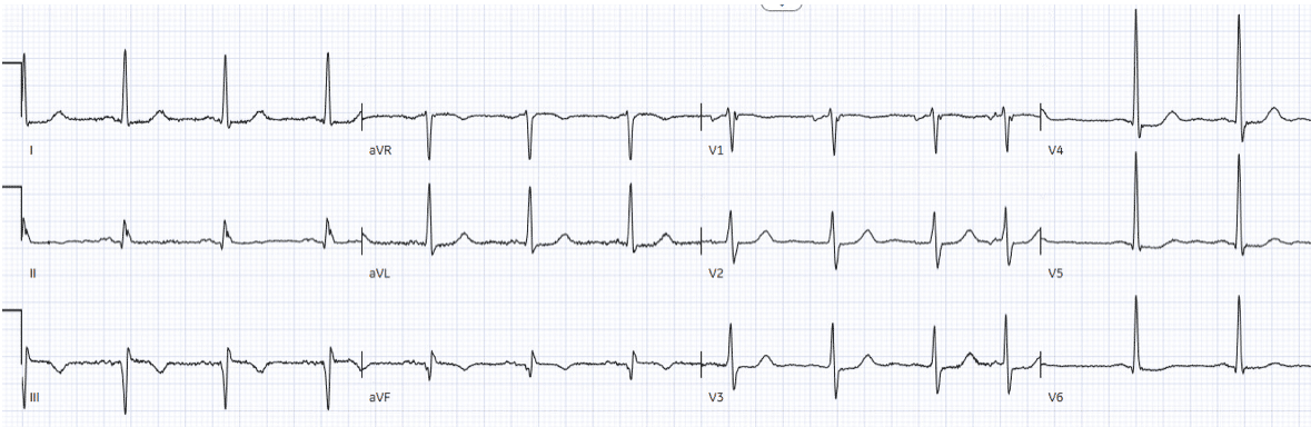 The ECG in the diagnosis of aortic dissection | ECG Cases | EM Cases