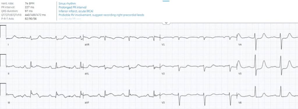 The ECG in the diagnosis of aortic dissection | ECG Cases | EM Cases