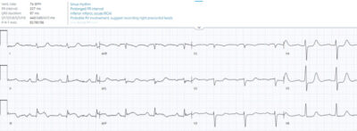 The ECG in the diagnosis of aortic dissection | ECG Cases | EM Cases