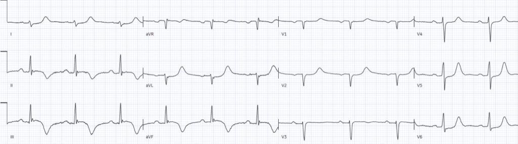 The ECG in the diagnosis of aortic dissection | ECG Cases | EM Cases