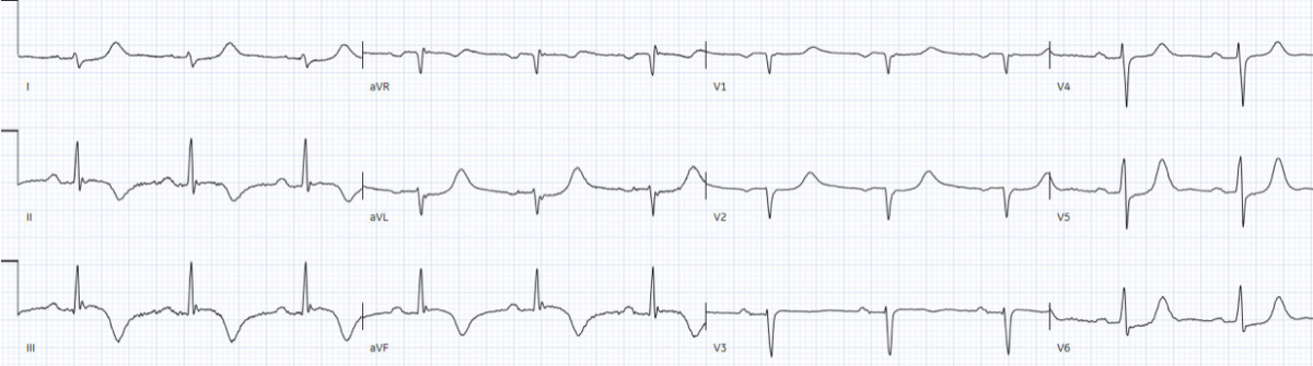 The ECG in the diagnosis of aortic dissection | ECG Cases | EM Cases
