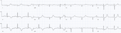 The ECG in the diagnosis of aortic dissection | ECG Cases | EM Cases