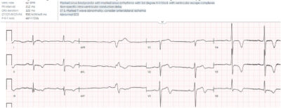 The ECG in the diagnosis of aortic dissection | ECG Cases | EM Cases