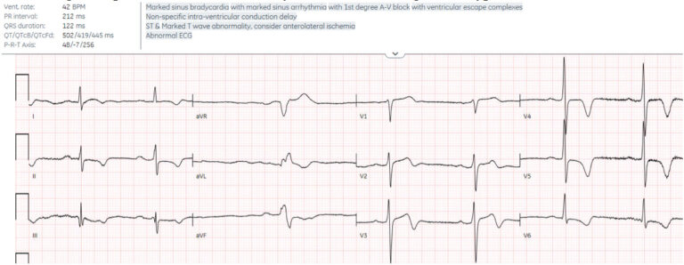 The ECG in the diagnosis of aortic dissection | ECG Cases | EM Cases