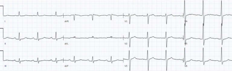 The ECG in the diagnosis of aortic dissection | ECG Cases | EM Cases