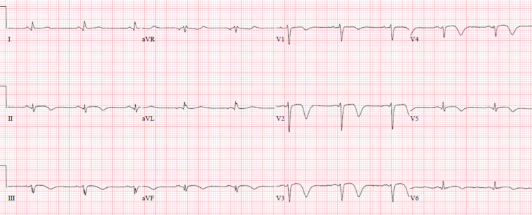 ECG Approach to Takotsubo syndrome | ECG Cases | EM Cases