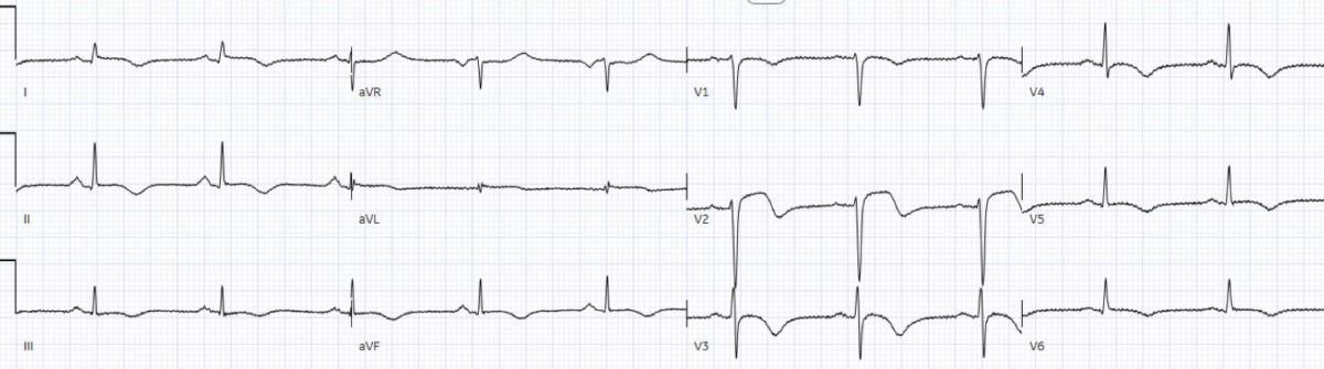 ECG Approach to Takotsubo syndrome | ECG Cases | EM Cases