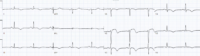 ECG Approach to Takotsubo syndrome | ECG Cases | EM Cases