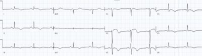ECG Approach to Takotsubo syndrome | ECG Cases | EM Cases