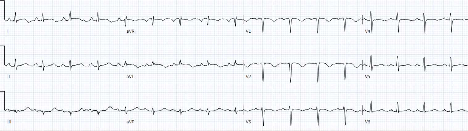 ECG Approach to Takotsubo syndrome | ECG Cases | EM Cases