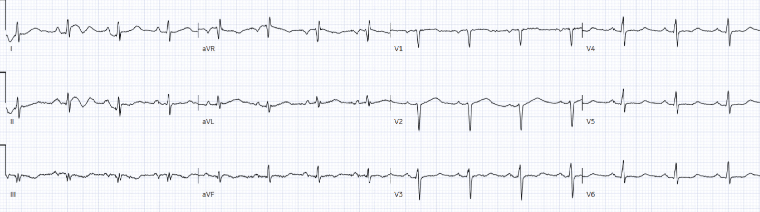 ECG Approach to Takotsubo syndrome | ECG Cases | EM Cases