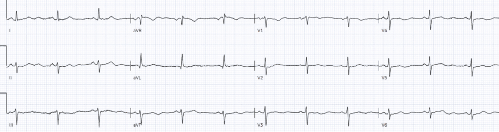 ECG Approach to Takotsubo syndrome | ECG Cases | EM Cases