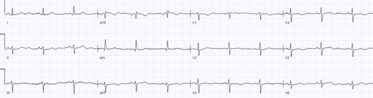 ECG Approach to Takotsubo syndrome | ECG Cases | EM Cases