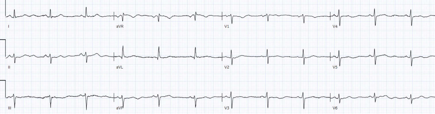 ECG Approach to Takotsubo syndrome | ECG Cases | EM Cases