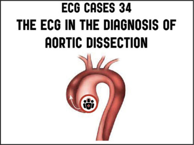 The ECG in the diagnosis of aortic dissection | ECG Cases | EM Cases