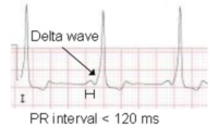Syncope Simplified | Emergency Medicine Cases