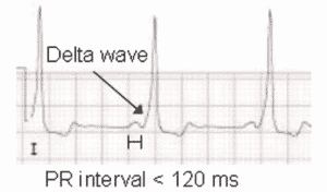 Syncope Simplified | Emergency Medicine Cases