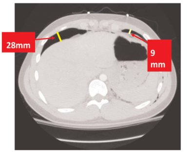 Saving EM: Is Less More? Traumatic Pneumothorax | EM Cases