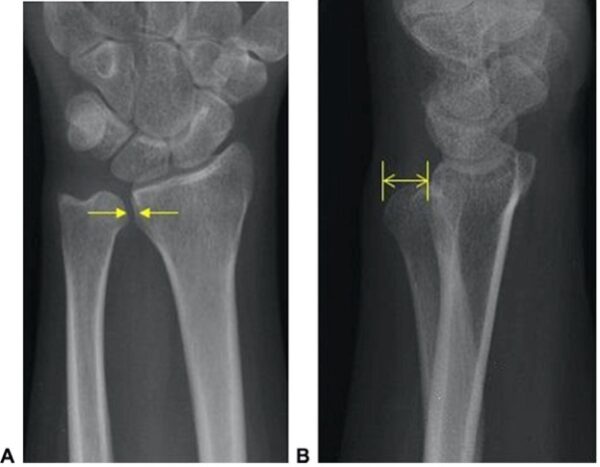 Emergency Orthopedics Differential Diagnosis - SCARED OF mnemonic | EM ...