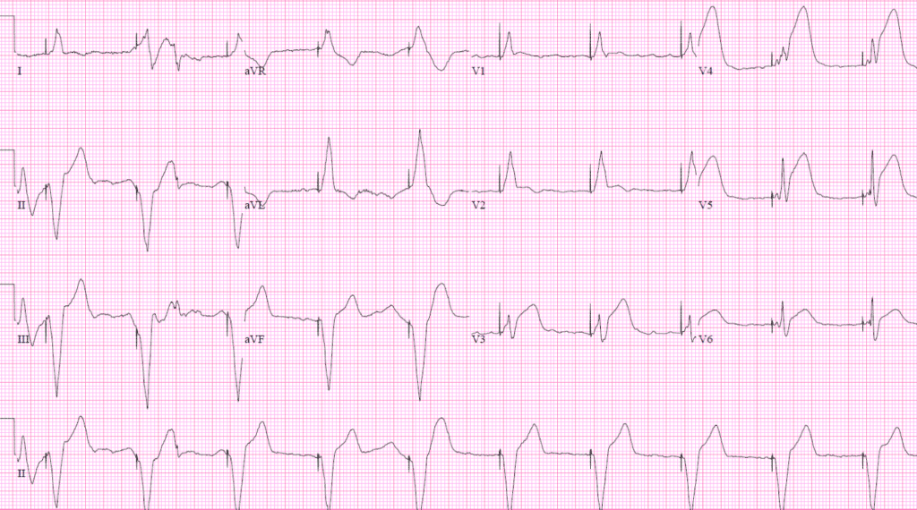 PACER mnemonic approach to pacemaker patients | ECG Cases | EM Cases
