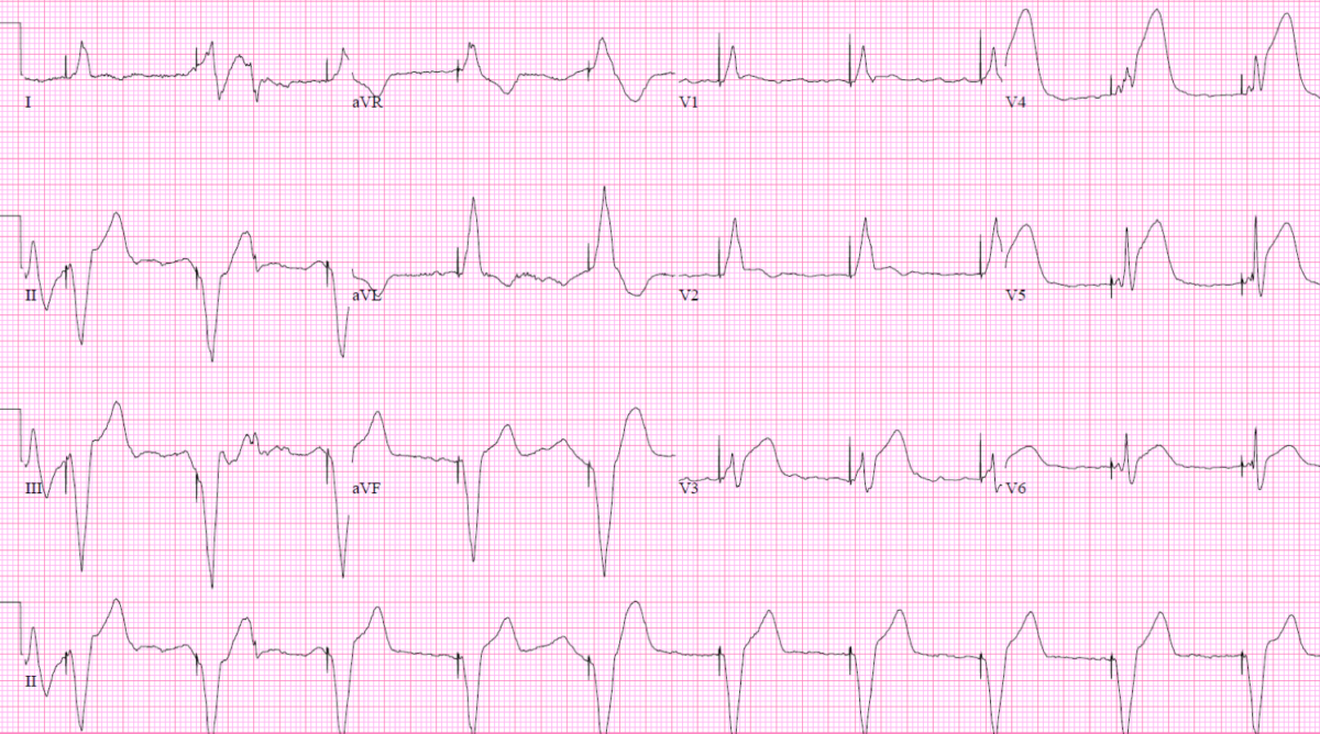PACER mnemonic approach to pacemaker patients | ECG Cases | EM Cases