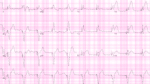 PACER mnemonic approach to pacemaker patients | ECG Cases | EM Cases