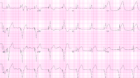 PACER mnemonic approach to pacemaker patients | ECG Cases | EM Cases