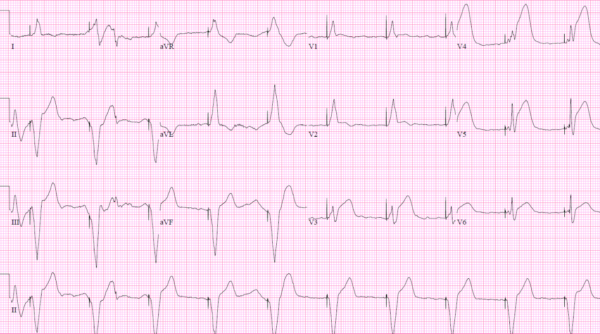 PACER mnemonic approach to pacemaker patients | ECG Cases | EM Cases