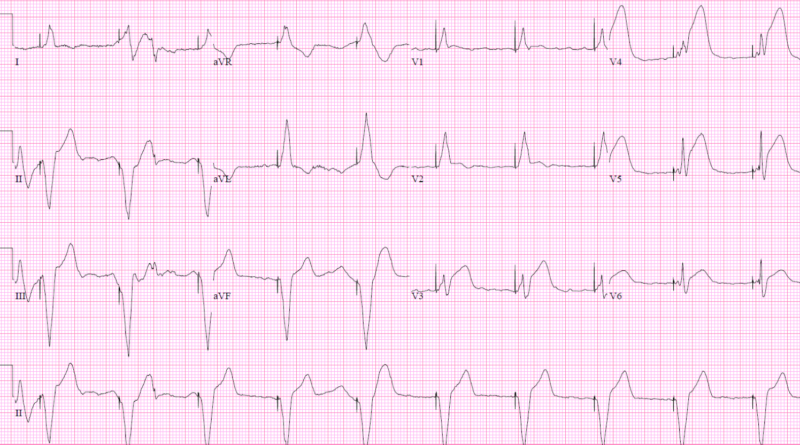 PACER mnemonic approach to pacemaker patients | ECG Cases | EM Cases