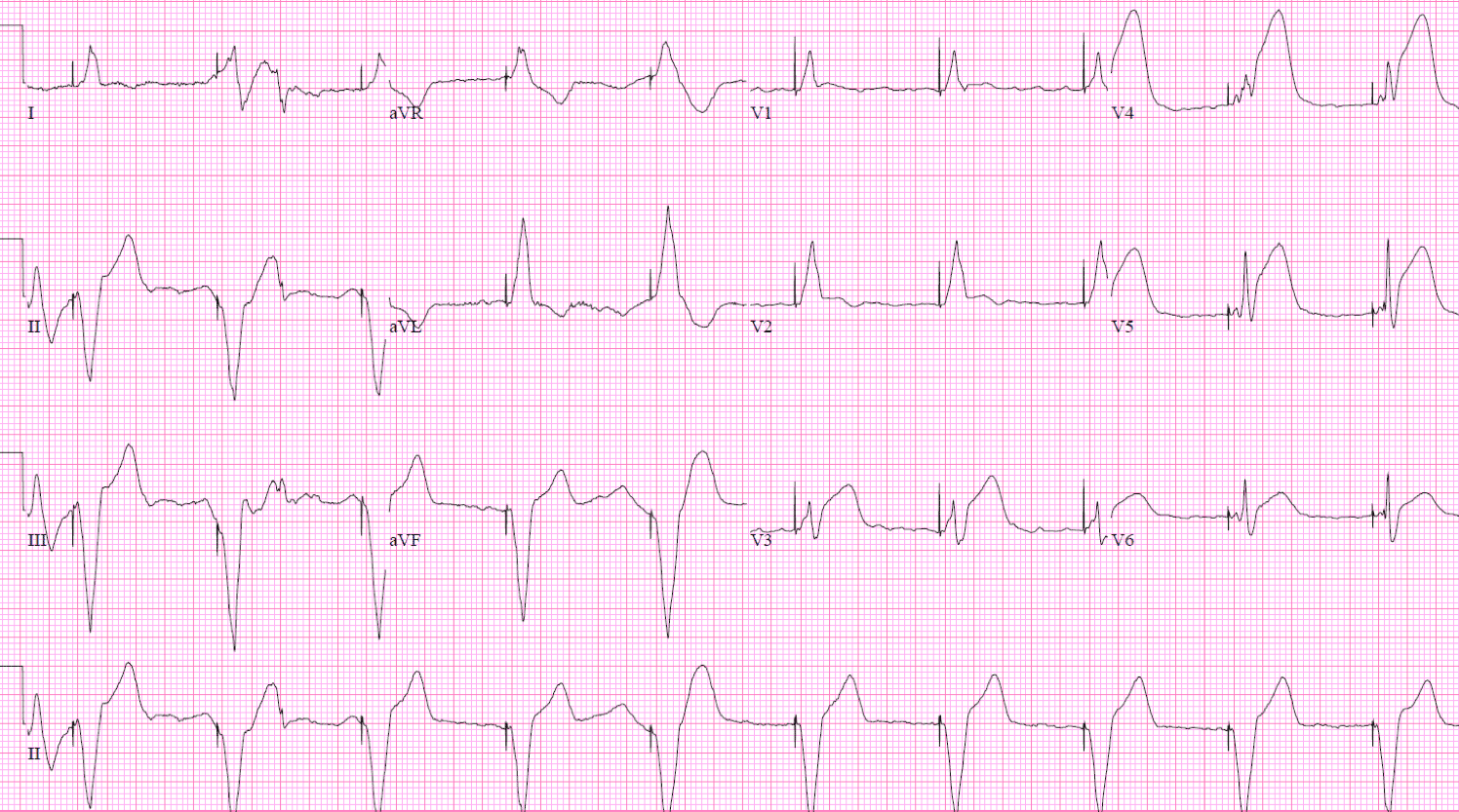 PACER mnemonic approach to pacemaker patients | ECG Cases | EM Cases