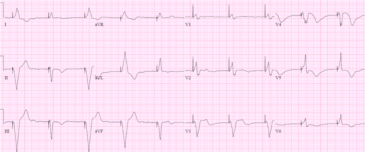 PACER mnemonic approach to pacemaker patients | ECG Cases | EM Cases