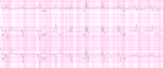 PACER mnemonic approach to pacemaker patients | ECG Cases | EM Cases