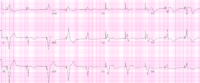 PACER mnemonic approach to pacemaker patients | ECG Cases | EM Cases