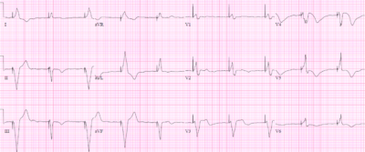 PACER mnemonic approach to pacemaker patients | ECG Cases | EM Cases