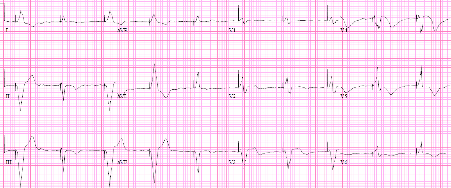 PACER mnemonic approach to pacemaker patients | ECG Cases | EM Cases